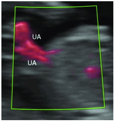 Microvascular Flow Imaging In A Transverse Plane Of A Fetus At 11