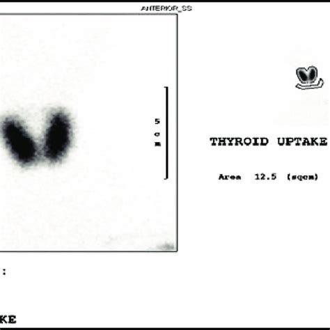 Radioisotope Thyroid Scan Showing Abnormally High Thyroid Uptake Download Scientific Diagram