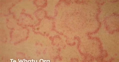 Targetoid Lesion In Urticaria Image