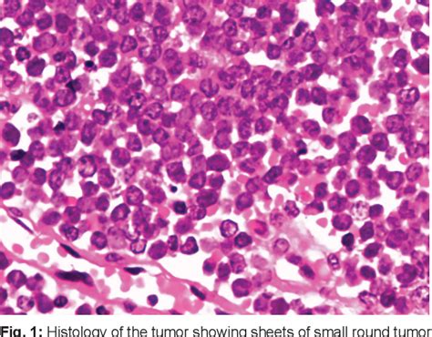 Figure 1 From A Rare Case Of Primary Spinal Primitive Neuroectodermal