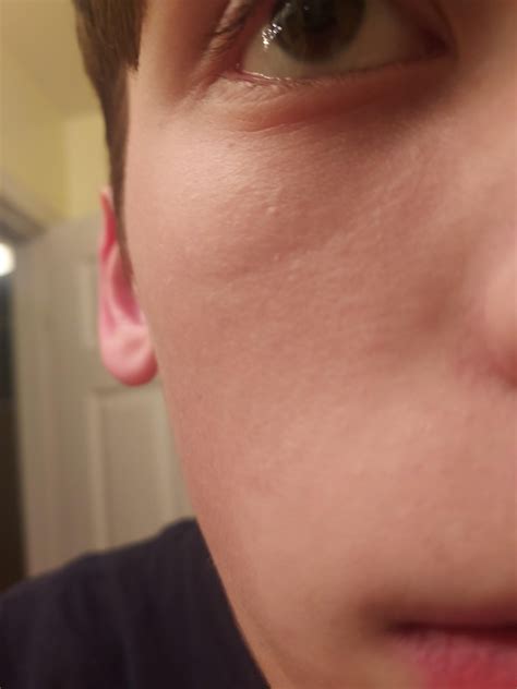 what are these indents and lines on my face i am 15 r skincare addiction