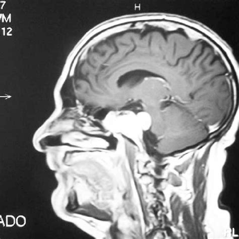 Tumour Affecting Internal Carotid Artery And Cavernous Sinus Download