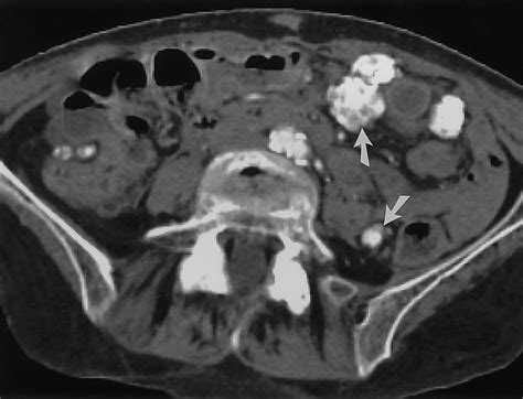 Mesenteric Neoplasms Ct Appearances Of Primary And Secondary Tumors