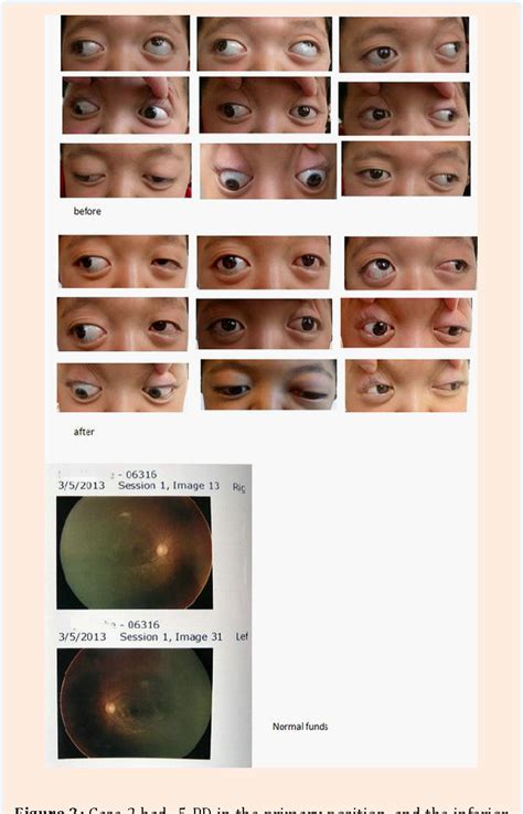 Figure 2 From Surgical Treatment Of V Pattern Exotropia In Crouzon Syndrome Semantic Scholar