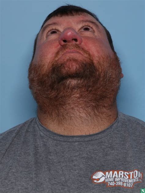 Real Patient Case 3046 Smith Facial Plastics Columbus Oh