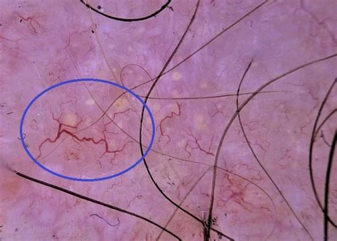 Vessel Patterns In Dermoscopy