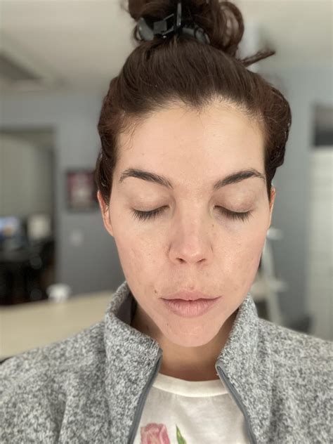 Acne Pock Marks Racnescars