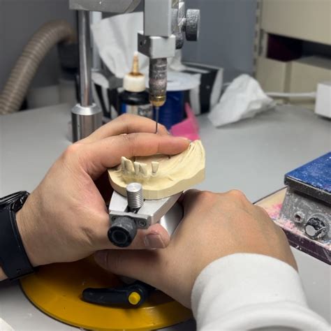 A Dental Lab Case Study 101 How To Create A Custom Cast Partial Denture For Differentiated