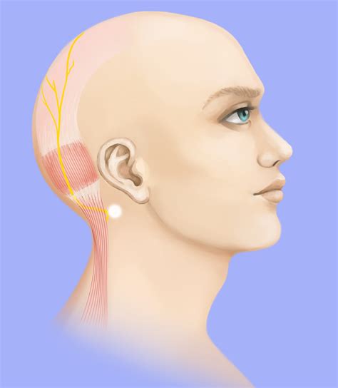 Trigger Point Release And Nerve Decompression For Migraines And Chronic Headaches