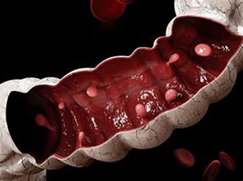 Cold Versus Hot Snare Polypectomy Cuts Risk For Delayed Bleeding Physicians Weekly