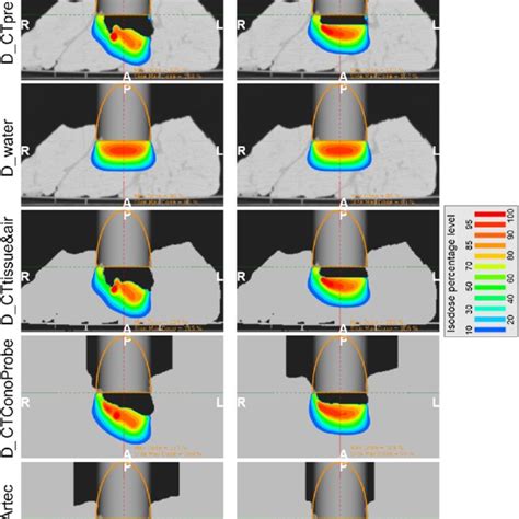 3d dose distributions calculated using the monte carlo algorithm axial