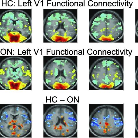 Homotopic Primary Visual Cortex Functional Connectivity Is Correlated Download Scientific