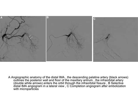 Embolization For Epistaxis Ppt