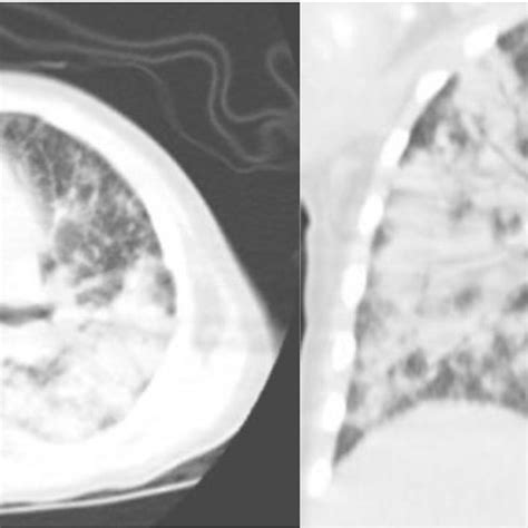 A Case 1 Lung Ct Showed The Patchy High Density And Strip Shaped Download Scientific Diagram
