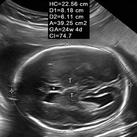 Sonographic Assessment Of Fetal Growth Abnormalities Radiographics