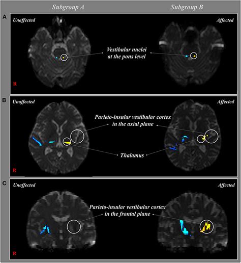 Vestibular Cortex