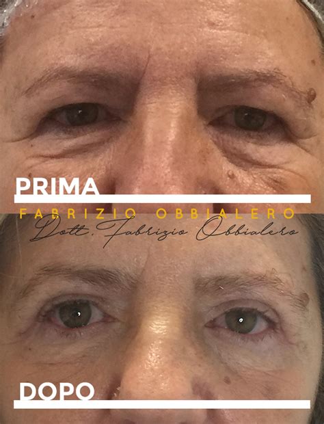 Esempio Blefaroplastica Superiore Prima E Dopo Dott Obbialero Fabrizio