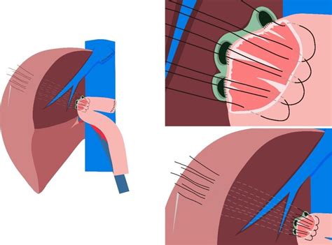 Hepato Jejunostomy After Left Hemihepatectomy It Is Used In Complex Download Scientific