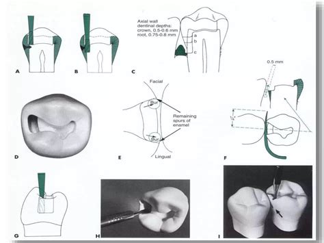 Class 2 Amalgam Restoration Pptx