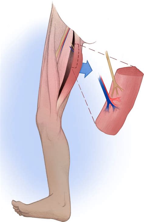 Anatomy Of Gracilis Free Muscle Transfer Harvest Demonstrating The