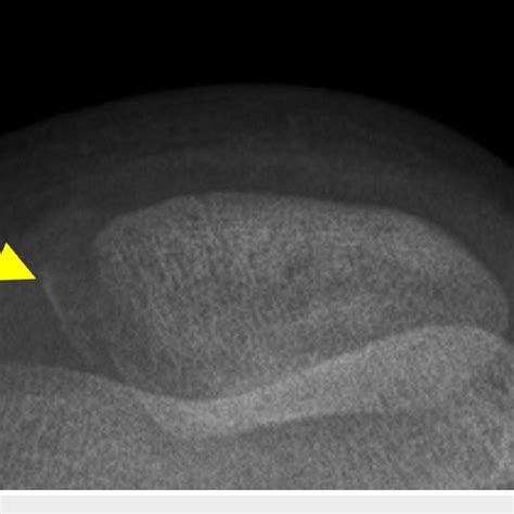 Mri Of Left Knee Patellar Attachment Of Mpfl A Frontal Plane The