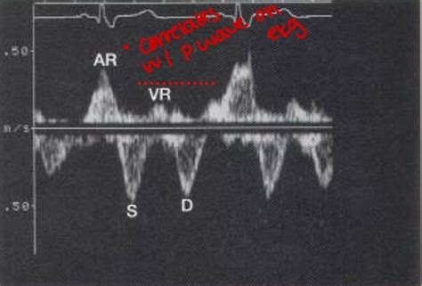 Echo Ch3 Intracardiac Flow Flashcards Quizlet