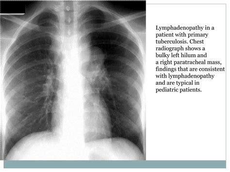 Role Of Radiology In Pulmonary Tuberculosis Pptx