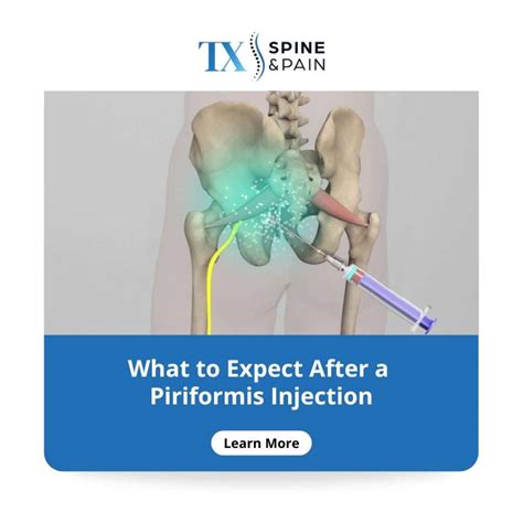 What To Expect After A Piriformis Injection
