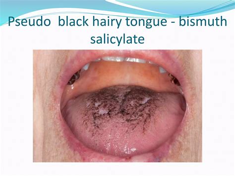 Tongue And Systemic Diseases Pptx