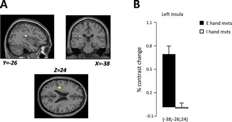 A Localization Of The Cluster Found In The Left Insular Cortex White