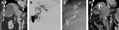 Imaging Of Hepatic Segment 4 Advances In Clinical Radiology