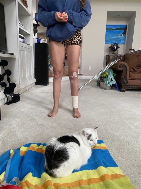 22 Days Post Op Atrophy Racl