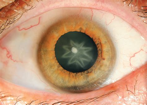 Rosette Cataract Signs Causes And Treatment