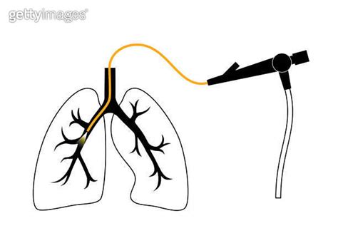 Bronchoscopy Procedure Concept 이미지 1500448048 게티이미지뱅크