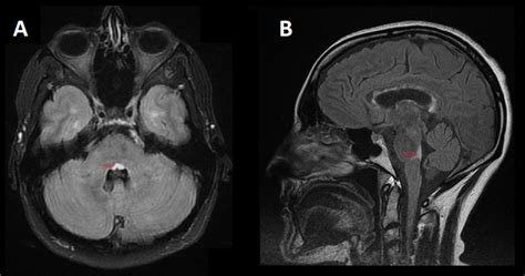 A Axial Flair Image Shows A Midline T2 Hyperintense Lesion Arrow In