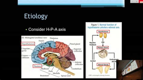 Diagnosis And Treatment Of Hypercortisolism 1 Lecture 204 Flashcards Quizlet
