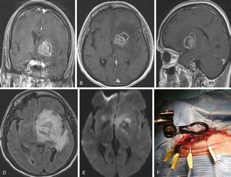Management Of Suppurative Intracranial And After Craniotomy Infections Clinical Tree