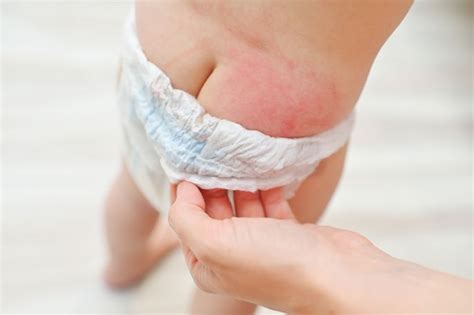 Dermatitis Causes Symptoms And Treatment W Photos Tua Saúde