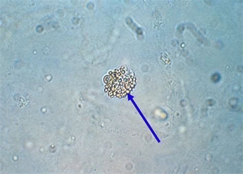 Epithelial Cells In Urine What Does It Mean If You Have Epithelial Cells In Urine