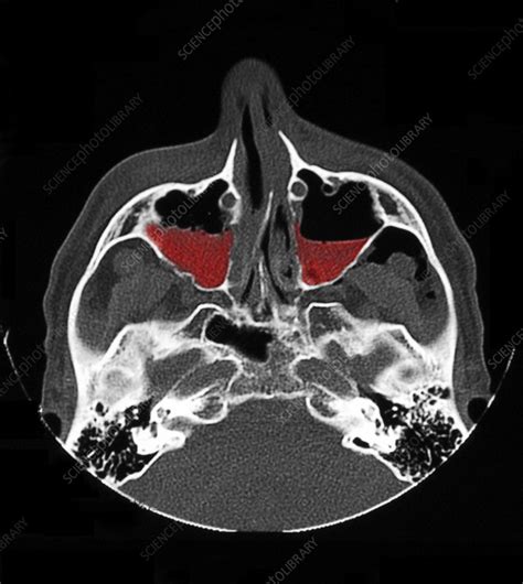 Maxillary Sinus Fractures Ct Stock Image C027 2691 Science Photo Library