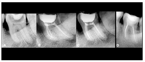 Success Of Endodontic Treatment At Jessica Bullard Blog