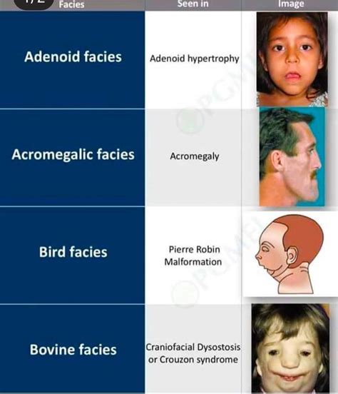 Adenoid Face Syndrome