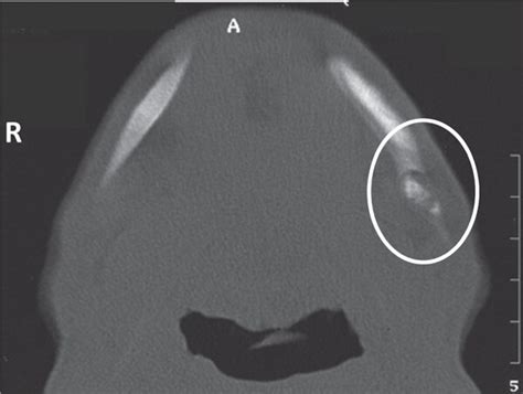 Mandibular Axial Computed Tomography Sections In Bone Window After
