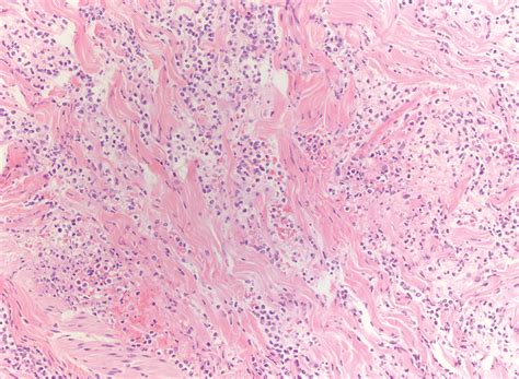 Histiocytoid Pyoderma Gangrenosum A Challenging Case With Features Of Sweet Syndrome Mdedge