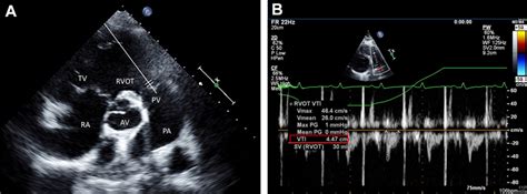 A Echocardiographic Parasternal Short Axis View At The Base Of The Download Scientific Diagram