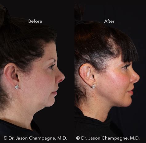 Rf Skin Tightening Before And After Dr Jason Champagne