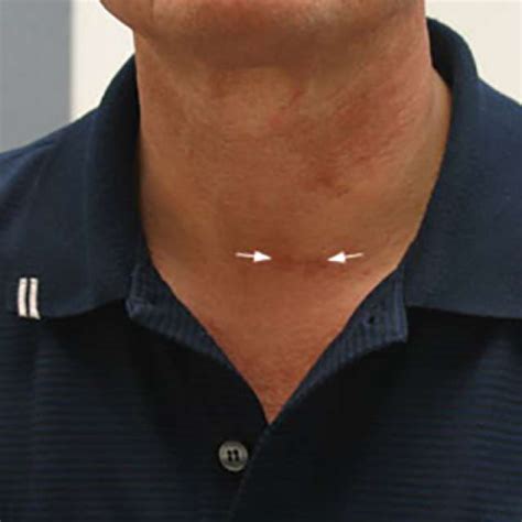 High Calcium Levels And Primary Hyperparathyroidism Endocrine Surgery Ucla Health