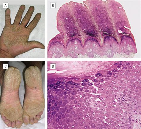 Epidermolytic Palmoplantar Keratoderma Palmoplantar Keratoderma And Pleomorphic Adenoma Of
