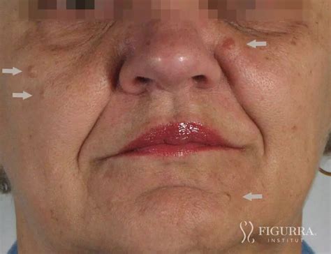 Bumps And Lesions Institut Figurra