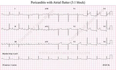 Killer Ecg Patterns Part 1 Artofit